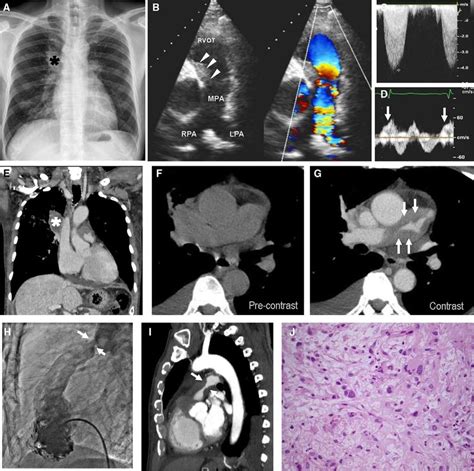 Figure Final Diagnosis Confirmed By Multimodality Imaging And