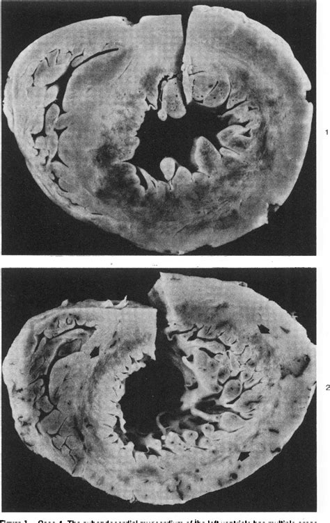 Figure 1 From Subendocardial Ischemic Myocardial Lesions Associated
