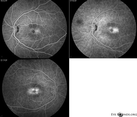 Idiopathic Juxtafoveal Retinal Telangiectasis