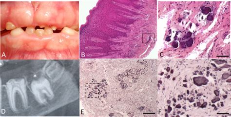 Gingival And Dental Follicle Ectopic Calcifications In Patients With Download Scientific