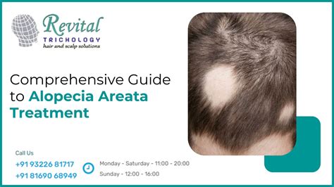 Alopecia Areata Treatment Causes Options And Expert Guide