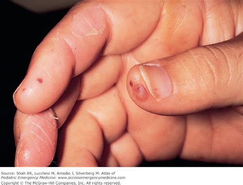 Caso 81 Endocarditis Aórtica Por Staph Aureus Guía Terapéutica