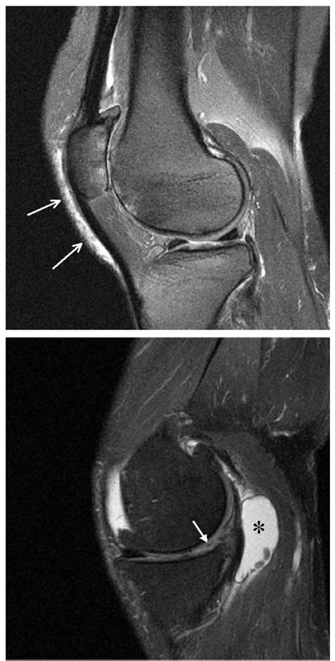 Periarticular Bursitis And Cysts A Fluid Signal Over The