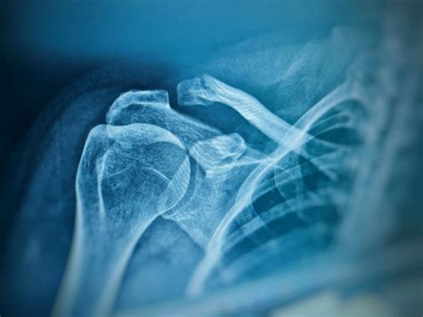 13 Caput Humerus Royalty Free Photos And Stock Images Shutterstock