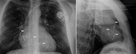 Biventricular Pacemaker Chest X Ray Biventricular Pacemaker Chest X Ray