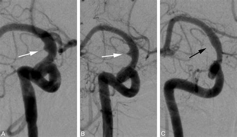 The Efficacy Of Endovascular Stenting In The Treatment Of Supraclinoid