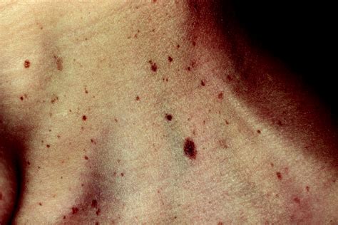 Leopard Syndrome Cardiac Imaging Findings Ajr