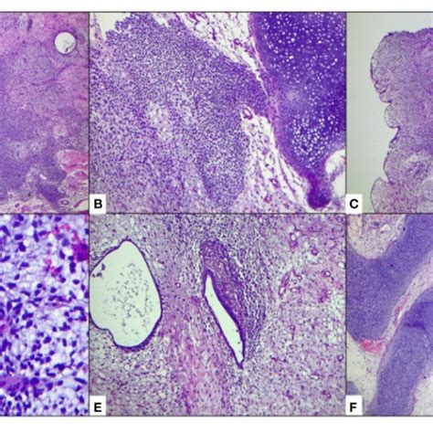 Uterine Adenosarcoma As Axial A And Sagittal B T2wi Show An