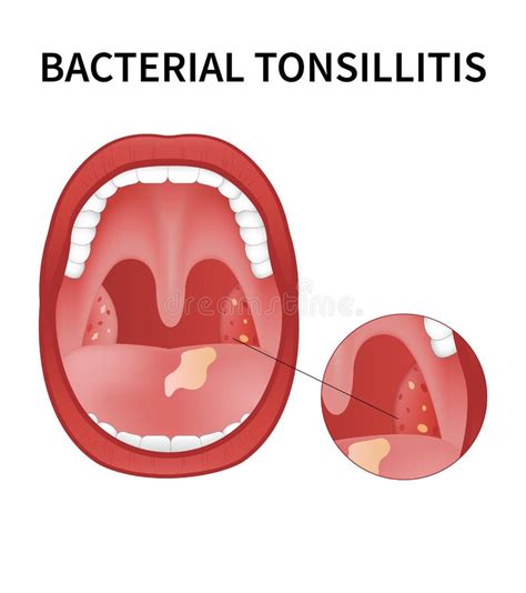 Bacterial Tonsillitis Vs Viral Tonsillitis