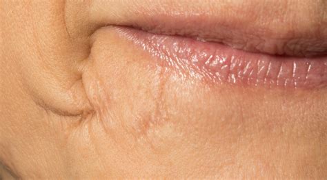 Administering Lip Filler When A Scar Is Present Harley Academy