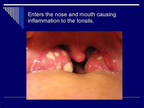 Tonsillitis
