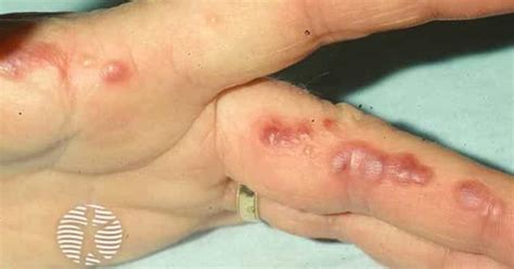 Dyshidrotic Eczema Pompholyx Image