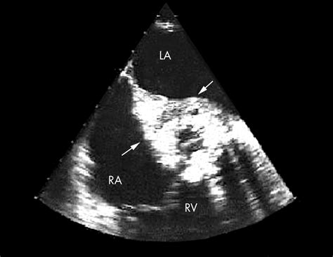 Infective Endocarditis Echo