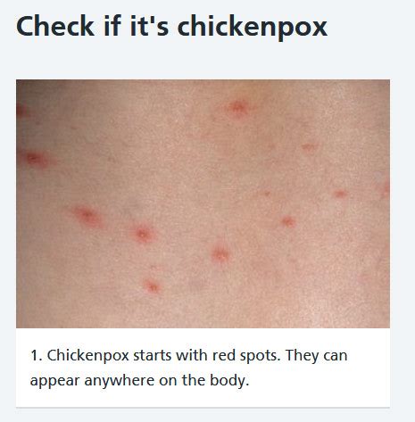 Chicken Pox Pictures Early Stages