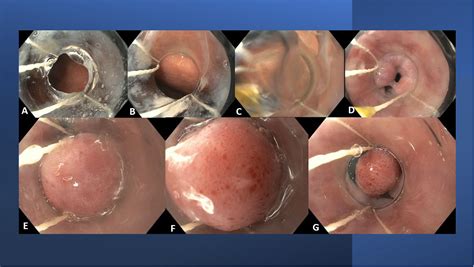 Quick Tips And Tricks For Endoscopic Band Ligation Of Esophageal Varices