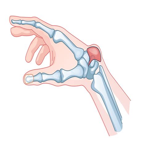 Known And Diagnosed Wrist And Hand Problems Leeds Community Healthcare