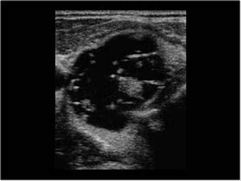 Head And Neck 41 Thyroid Gland Case 413 Thyroid Malignant