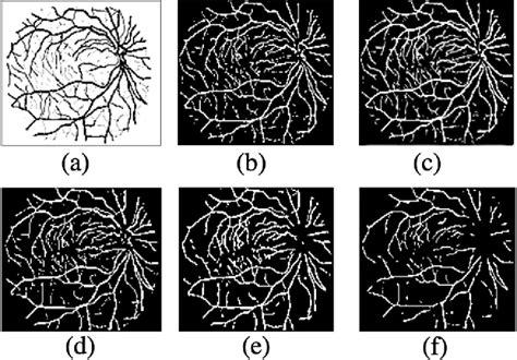 Figure 16 From Unsupervised Automated Retinal Vessel Segmentation Based