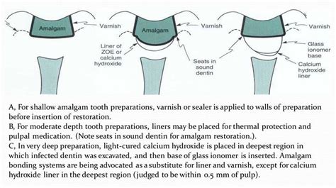 Fundamentals Of Tooth Preparation Part 2 Focus Dentistry