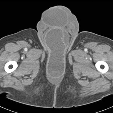 Ileal Conduit Radiology