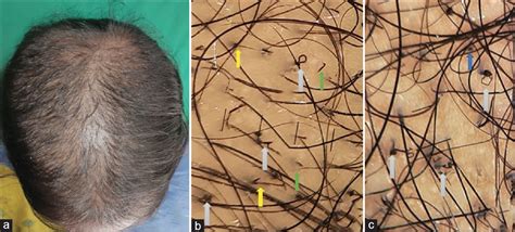 International Journal Of Trichology