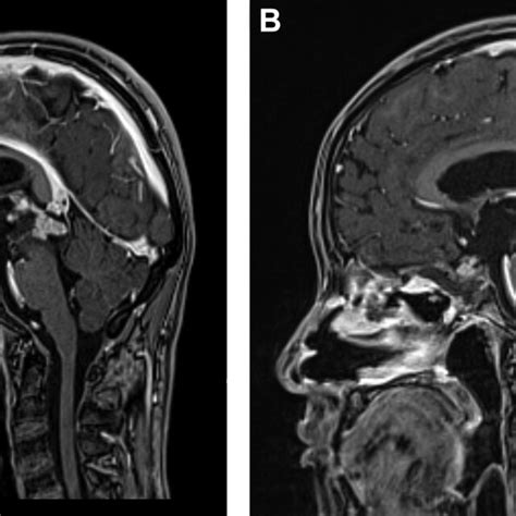 Case 1 A 13 Year Old Boy With A Pineal Mass And Hydrocephalus A A