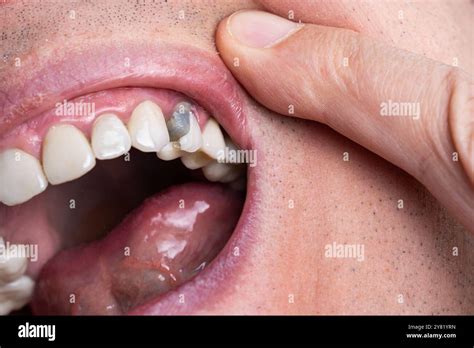 Caucasian Male Open Mouth And Teeth With Broken Upper Premolar Tooth