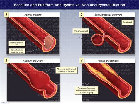Saccular And Fusiform Aneurysms Vs Non Aneurysmal Dilation