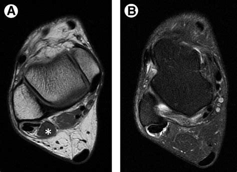Peroneus Quartus Mri