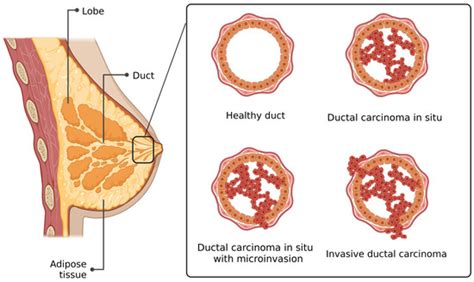 Dcis Progression And The Tumor Microenvironment Molecular Insights And