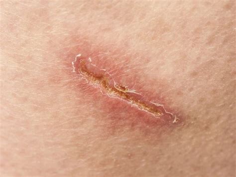 Comment Reconnaître Et Traiter Un Point De Suture Infecté Wemag