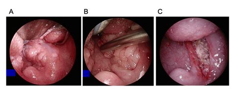 Endoscopic Powered Intracapsular Tonsillectomy And Adenoidectomy In