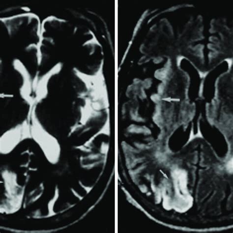 Acute And Subacute Cerebral Infarction Of Right Middle And Posterior