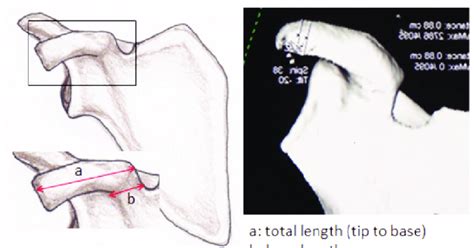 Coronal View Of Coracoid Process Download Scientific Diagram