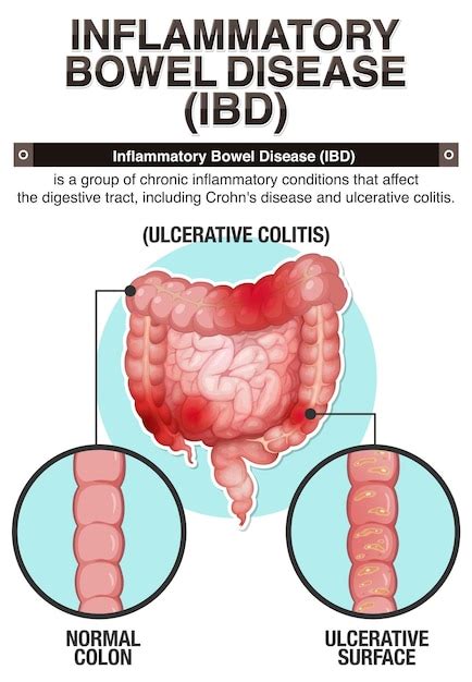 Premium Vector Inflammatory Bowel Disease Ibd Infographic