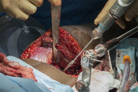 Tibial Plateau Fracture Posterior Column Fracture Fixed With Synthes