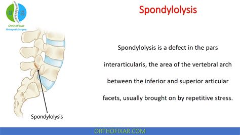 Spinal Spondylolysis Artofit
