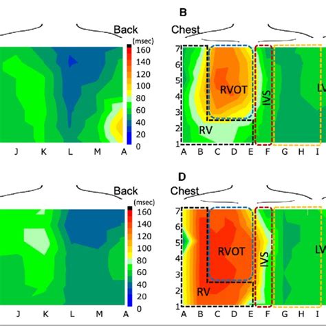 Interpretation Of The Ventricular Activation Time Map A The