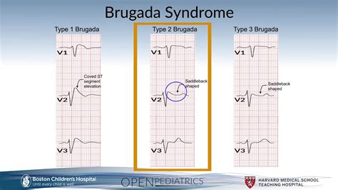 Brugada Syndrome By G Dhillon Openpediatrics Youtube