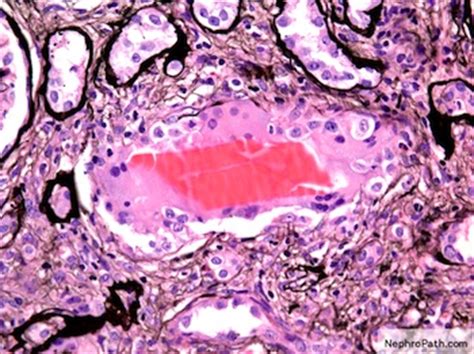 Pathology Outlines Light Chain Cast Nephropathy