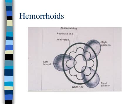 Ppt The Rectum And You Powerpoint Presentation Id 473298