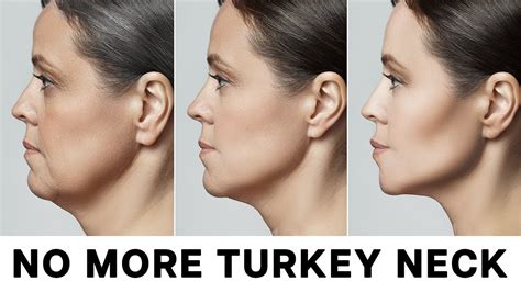 Get Rid Of Turkey Neck Dr Somji Recommends These Top Treatments Youtube