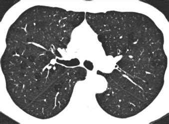 Lung Imaging In Copd Part 1 Chest