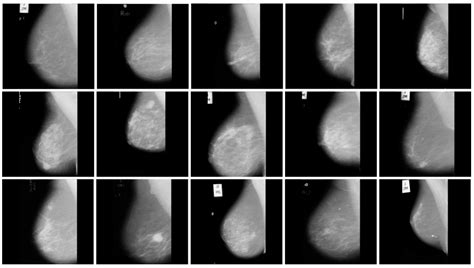 Attention Based Ensemble Network For Effective Breast Cancer