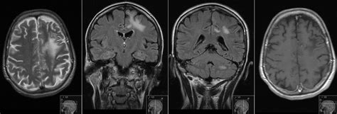 Progressive Multifocal Leukoencephalopathy Pml