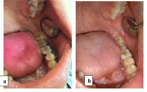 Figure 1 From Surgical Operculectomy Procedure In The Treatment Of