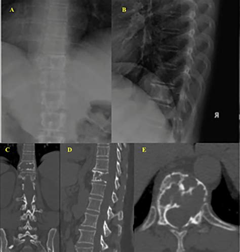 A B Anteroposterior And Lateral Radiograph Showed A Discrete Loss Of
