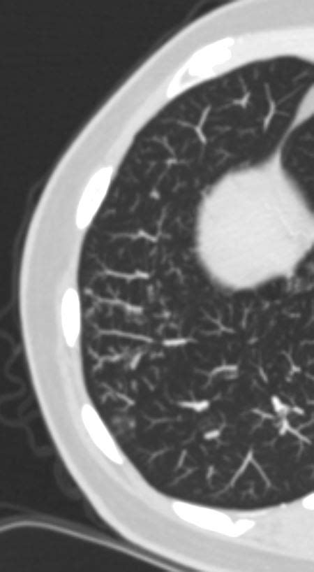 000 Tree In Bud Sign The Common Vein