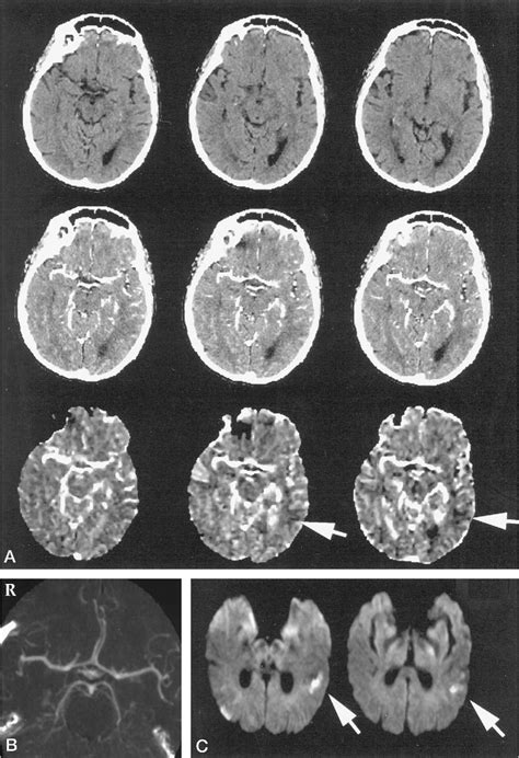 Figure 5 From Three Dimensional Functional Ct Early Anatomy In Hyperacute Stroke With