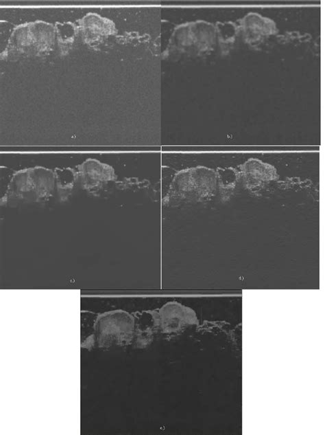 Oct Image Of The Breast Cancer Denoised Using A Rotating Kernel Download Scientific Diagram